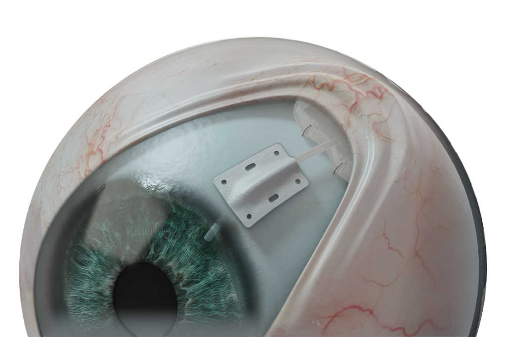 Synthetic scleral patch approved