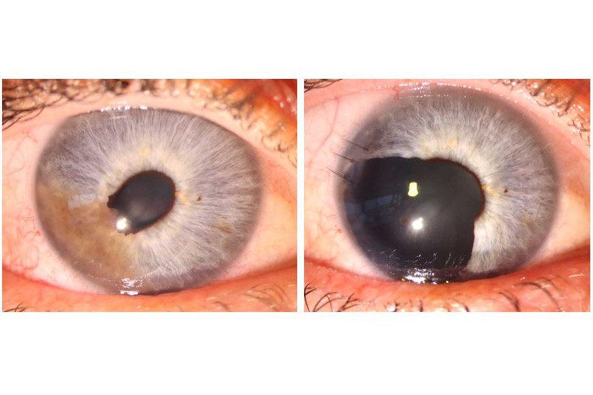 Contemporary surgical managment of iris tumours and reconstruction