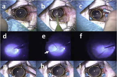Macula implant eye changes